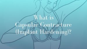 Capsular Contracture: Causes, Risks & Treatment | Dr Mark Kohout