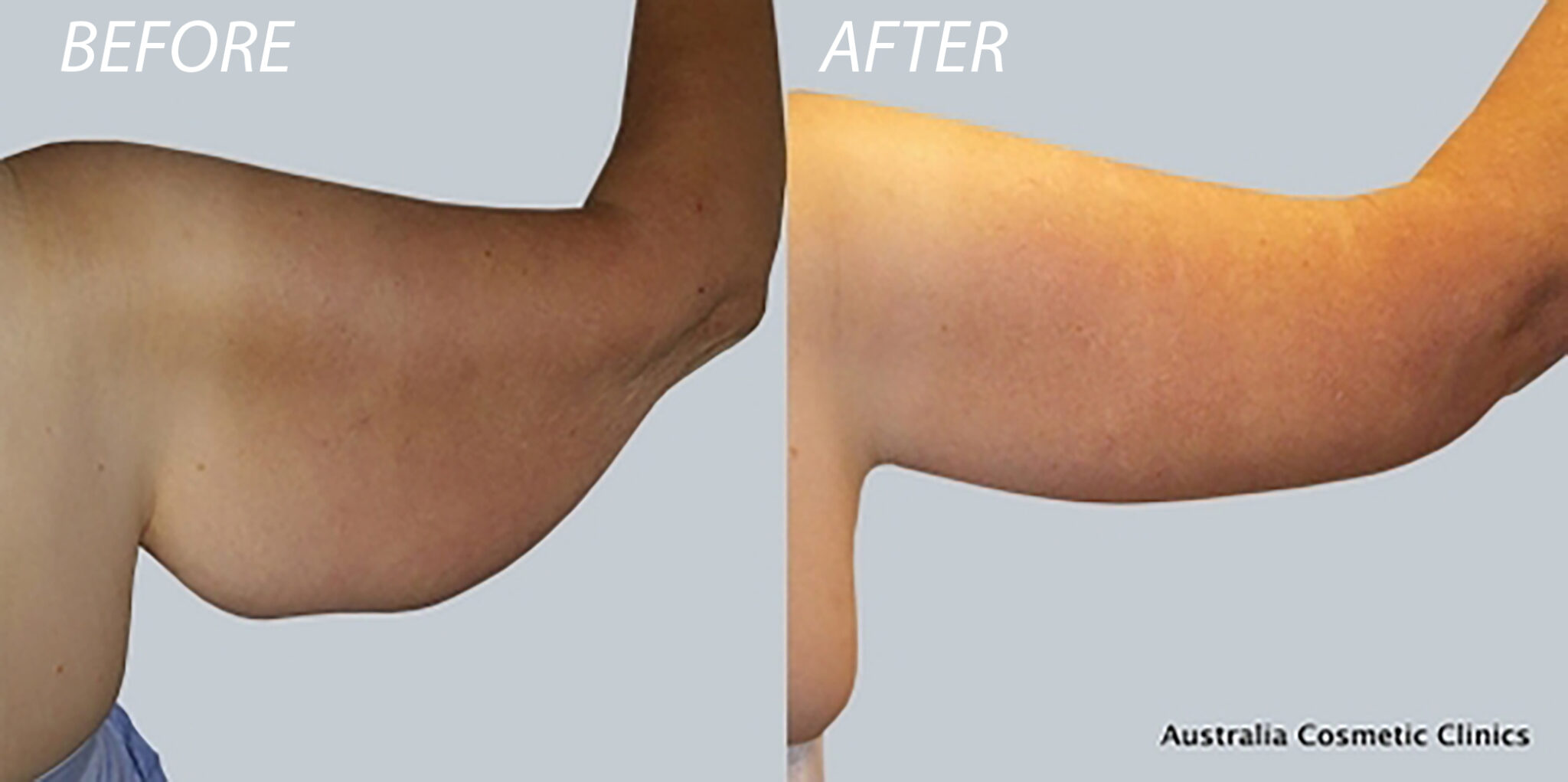 Arm Reduction Surgery Gallery - Dr Mark Kohout